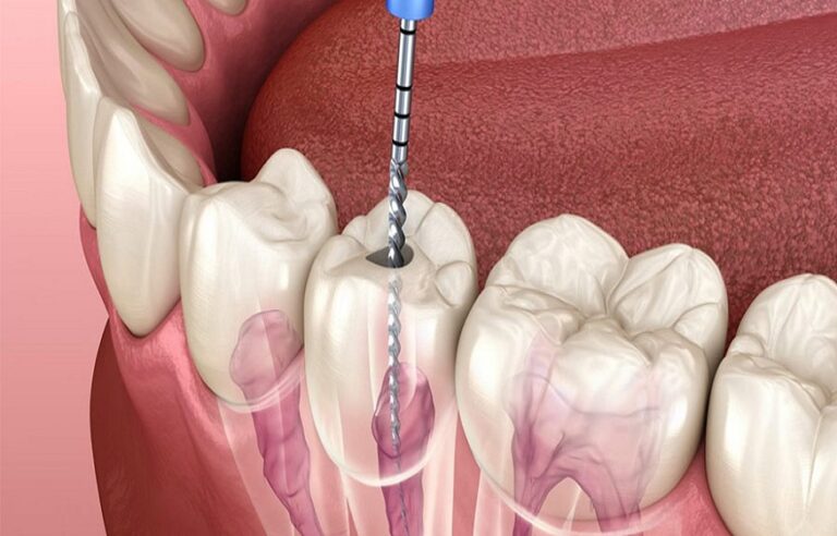 Exploring the Benefits of Single Sitting RCT Treatment ...